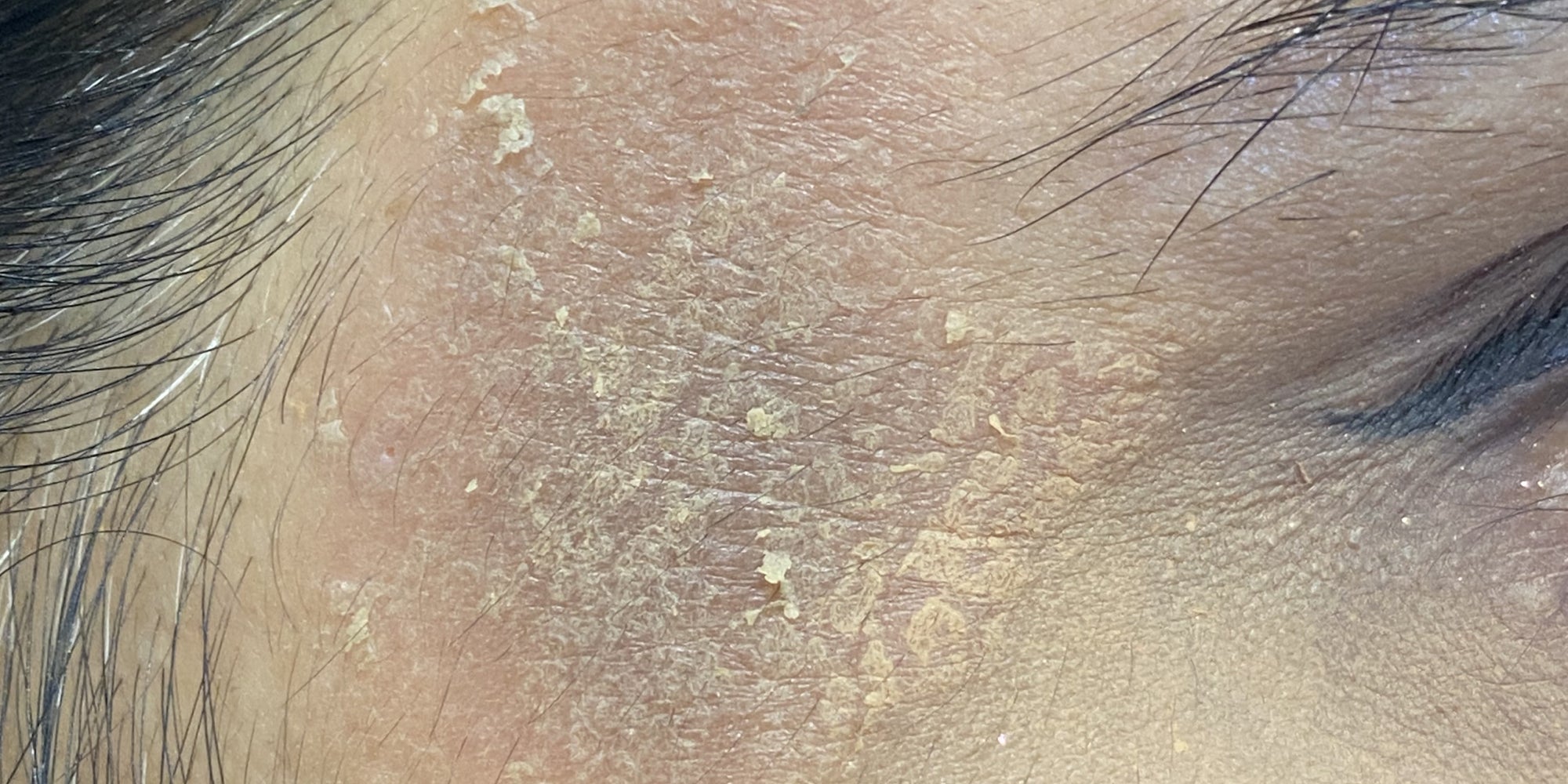 Liverty Dynamic Drops | Supplement for Eczema & Psoriasis